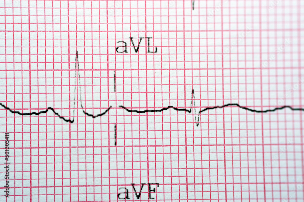 Photo & Art Print Electrocardiogram ECG in a graph paper shows normal ...