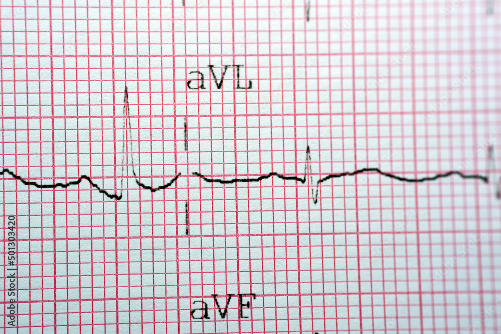 Electrocardiogram ECG in a graph paper shows normal Sinus rhythm, Vital ...