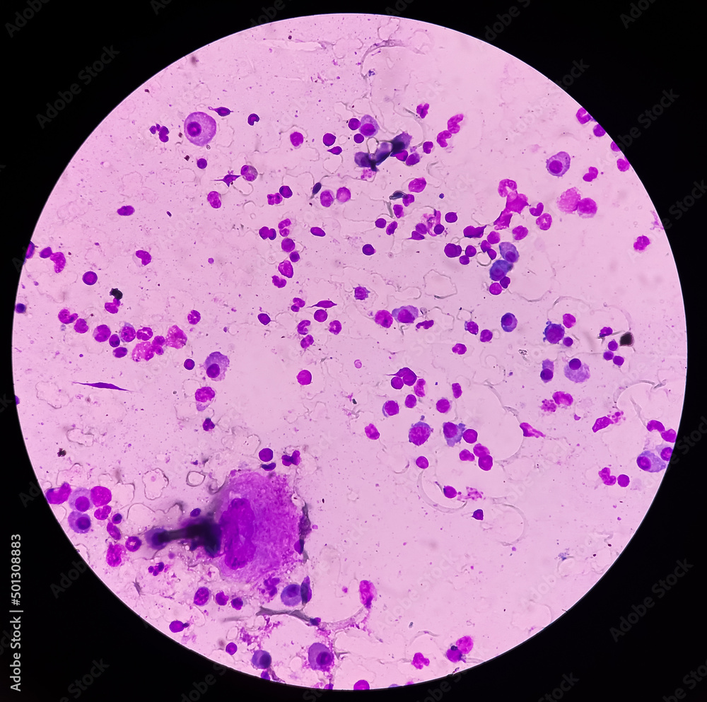 Bone marrow study: a megakaryocyte is a large bone marrow cell with a ...