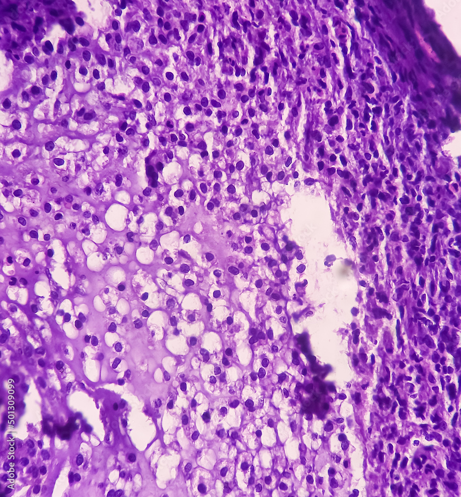 Stockfoto Fibroepithelial polyp of tongue, show fibrocollagenous tissue ...