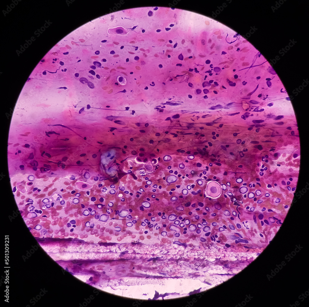 Squamous intraepithelial lesion(SIL). Pap's smear. Reactive cellular ...