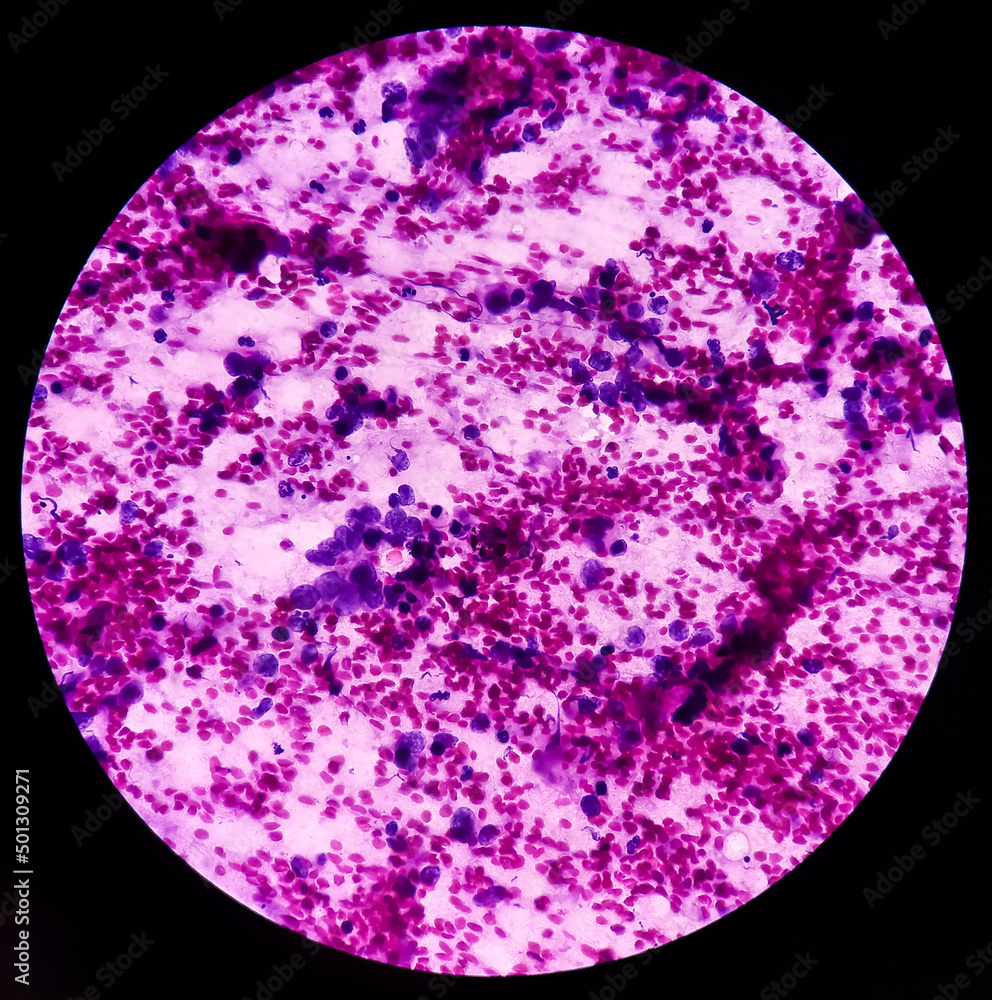 Hilar cancer, Hilar Enlargement, lung cancer, small cell carcinoma ...