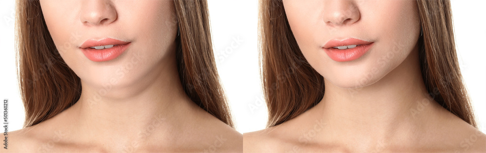 Double chin problem. Collage with photos of young woman before and ...