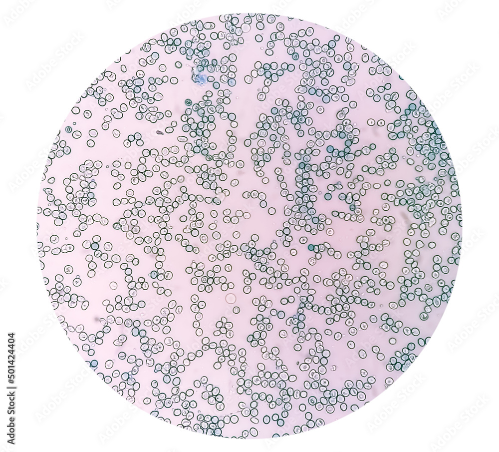 Close view of Reticulocyte count under microscope, methylene blue ...