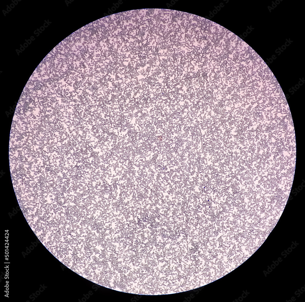 Close view of Reticulocyte count under microscope, methylene blue ...