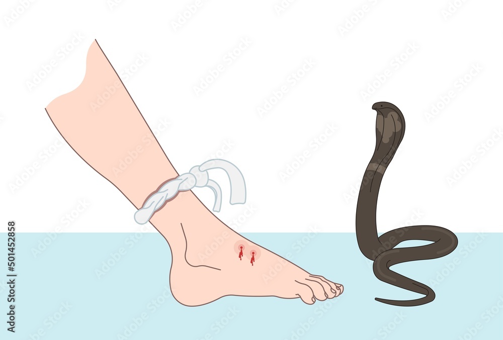 Snake Bite First Aid care non venomous anti venom serum hand leg king ...