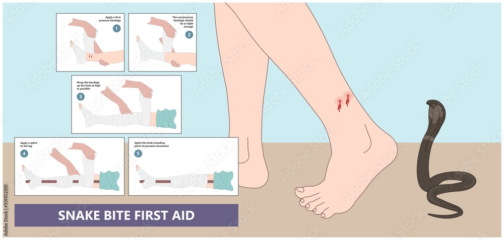 Snake Bite First Aid care non venomous anti venom serum hand leg king ...