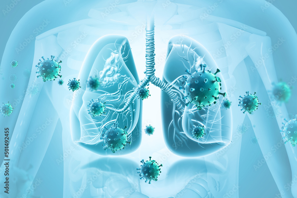 Cancer cells infected the Human Respiratory System.3d illustration ...