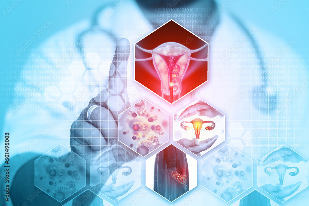 Doctor's hand shows female reproductive system diseases. Uterus cancer ...