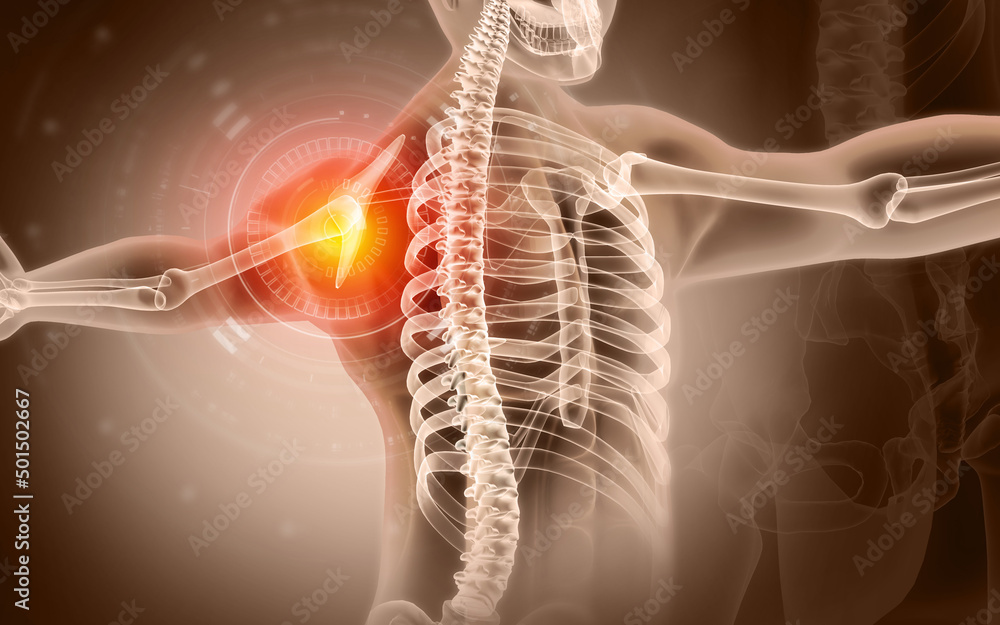 Human shoulder joint pain, x-ray view, shoulder ligament tendinitis ...