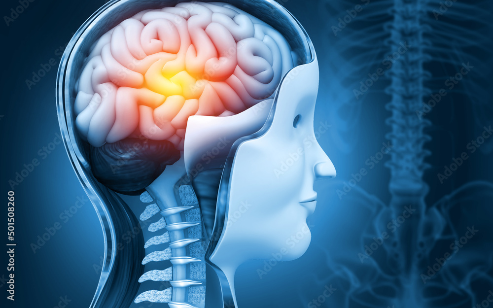 medically accurate illustration of a painful brain, Man with a headache ...