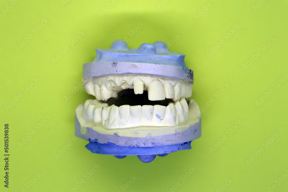Plaster casts of teeth. Preparation for prosthetics. Installation of ...