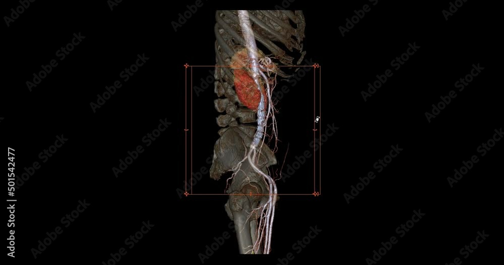 CTA Whole aorta 3D rendering turn around on the screen for diagnosis ...