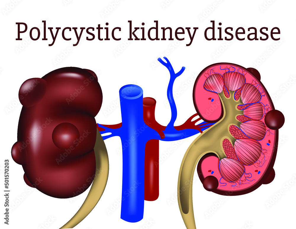 Polycystic kidney disease. genetic disease. Infographics of organs with ...