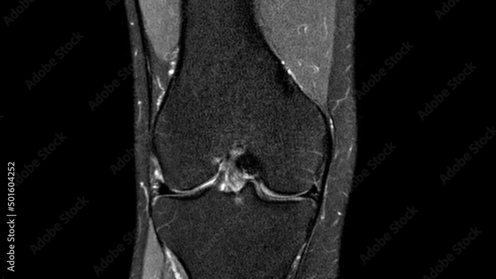 MRI knee joint. Magnetic resonance imaging of right knee. The concept ...