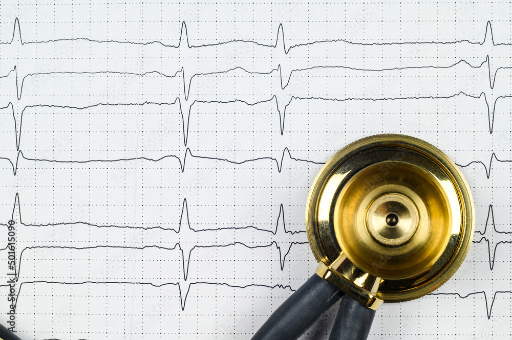 ECG with supraventricular extrasystole and phonendoscope.Premature ...
