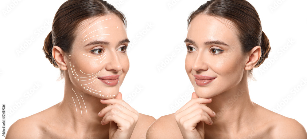 Beautiful young woman before and after skin lifting on white background ...
