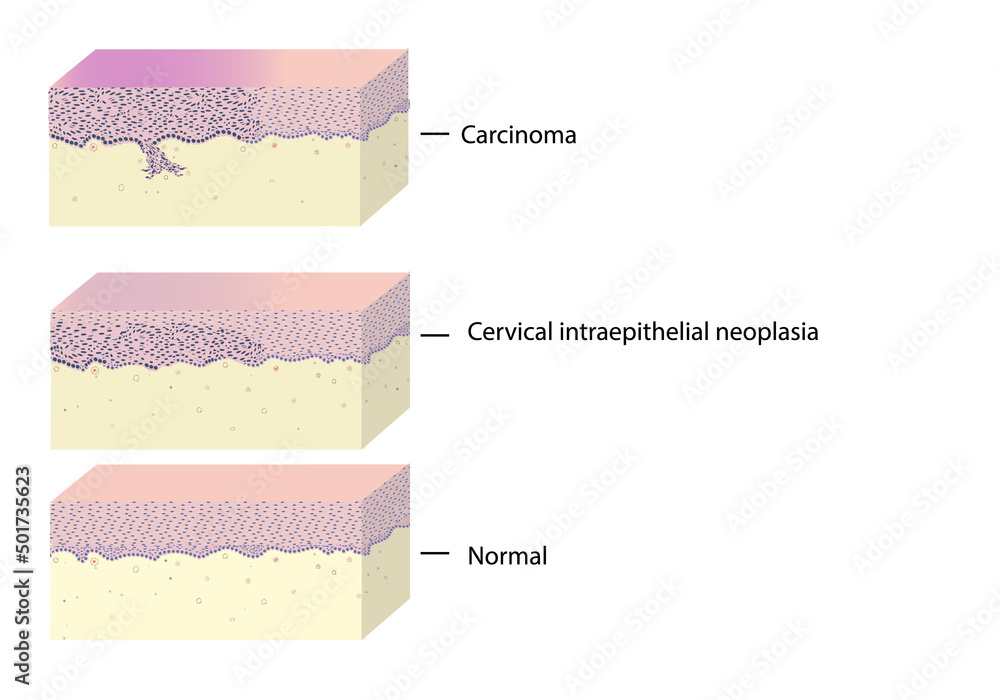 morphology of cervical cancer and cancerogenesis under a microscope ...