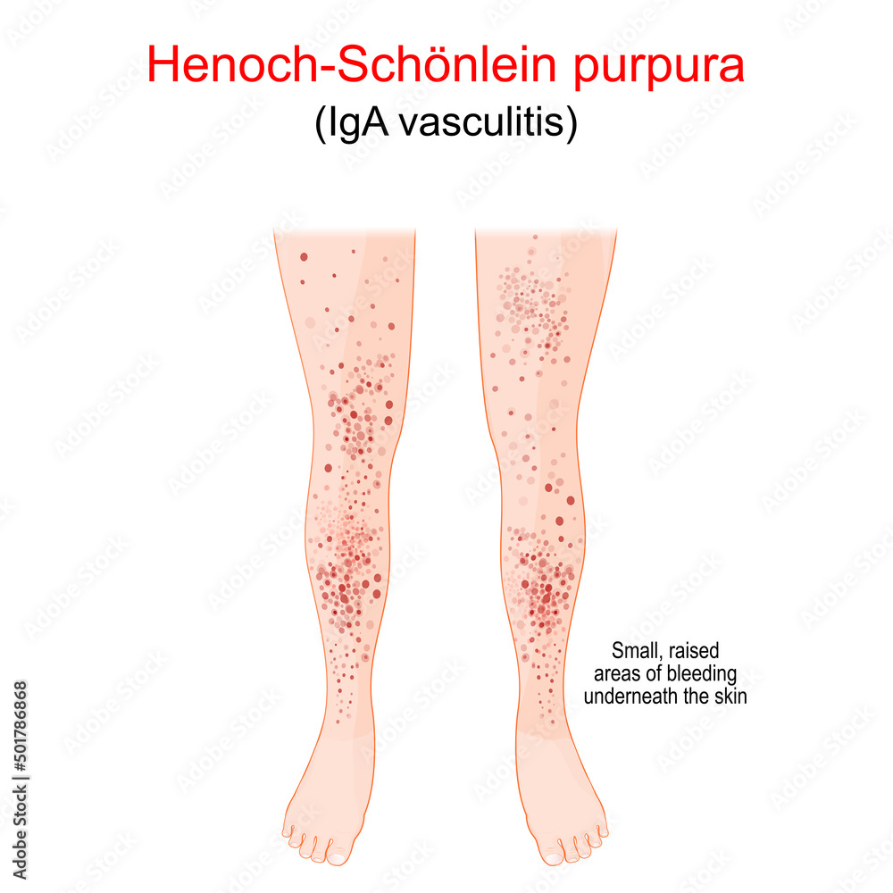 Henoch-Schönlein purpura. Spotty rash on the humans legs Stock Vector ...