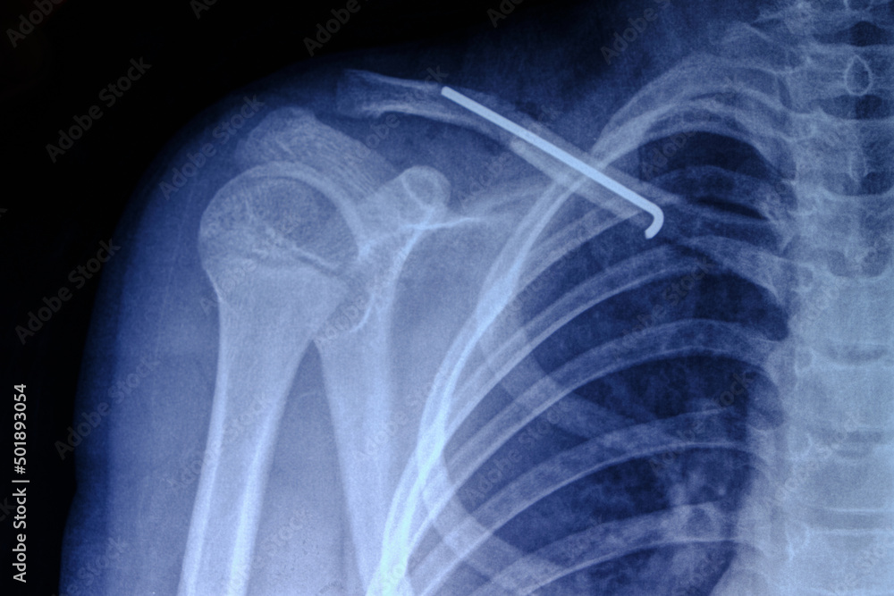 X ray image person with broken collarbone and spoke installed in it ...