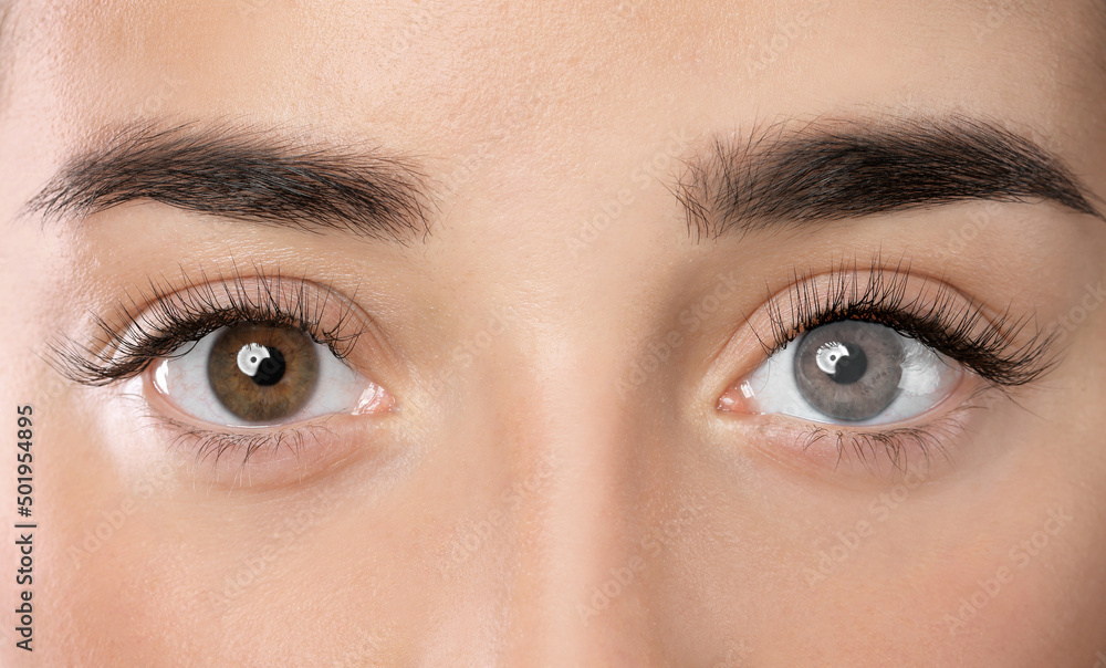 Woman with different colors of eyes, closeup. Heterochromia iridis ...