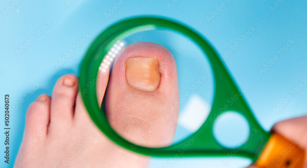 Ingrown Toenail Problem. Infected Patient Foot Check. Doctor ...