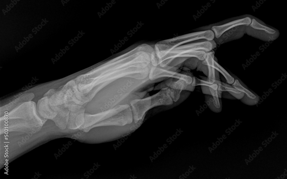 Xray of bent of human Hand fingers side view. X-ray of male hand and ...