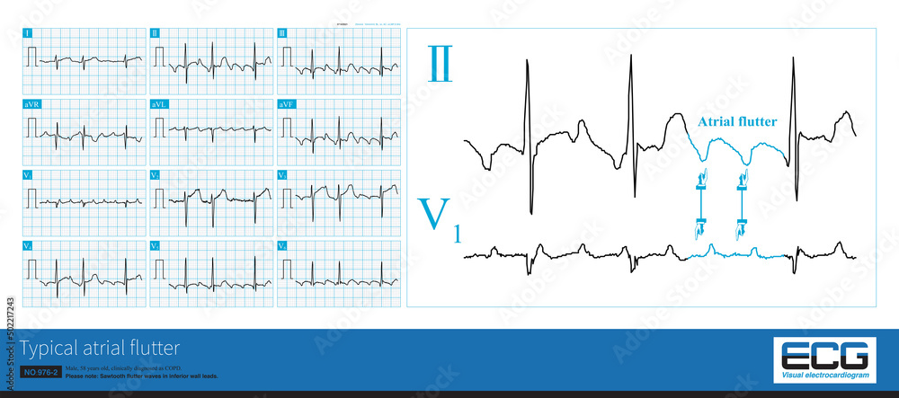 Male, 58 years old, clinically diagnosed as COPD. Paroxysmal atrial ...