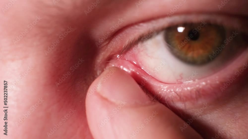 Macro video of the man's eye, the mucous membrane of the conjunctiva ...