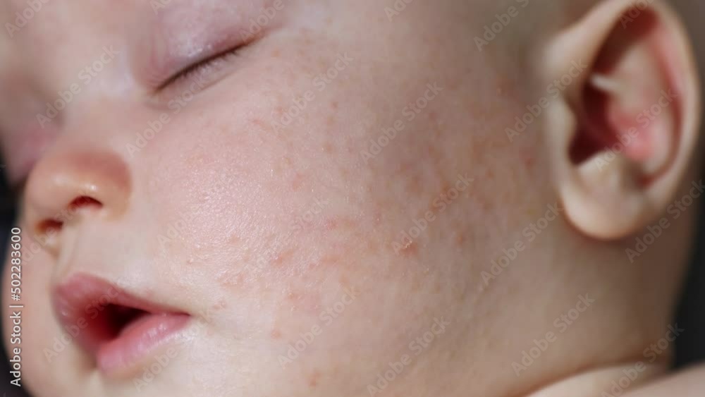 atopic dermatitis rush and allergic skin on baby infant cheek face ...