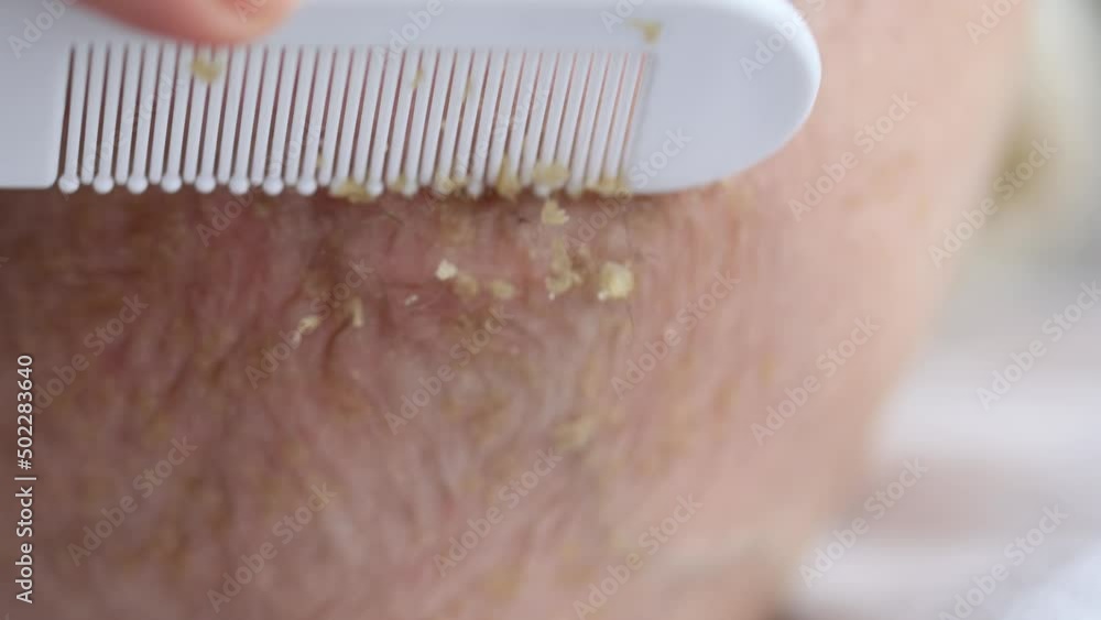 removing seborrheic dandruff flakes crusts off newborn baby child head ...