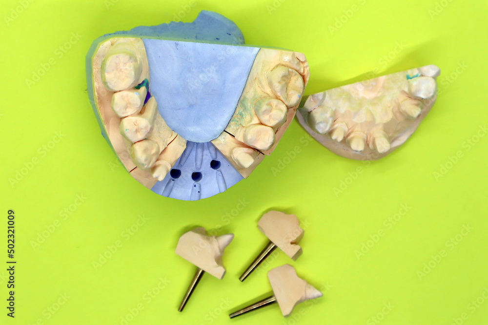 Plaster casts of teeth. Preparation for prosthetics. Installation of ...
