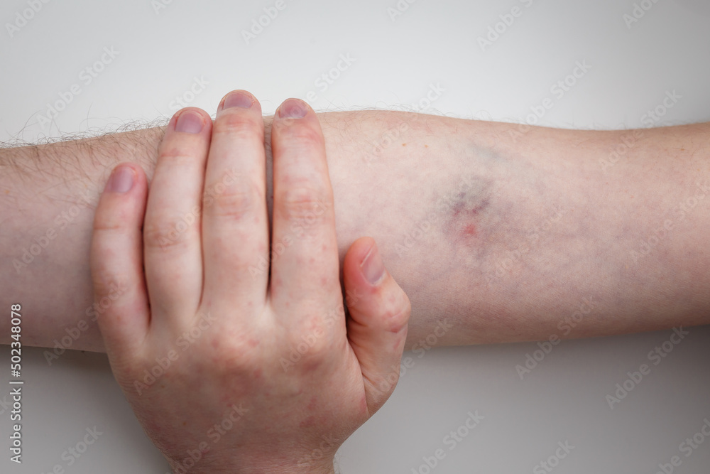 Drug addict holding arm with syringe injection mark and blue veins. Ill ...
