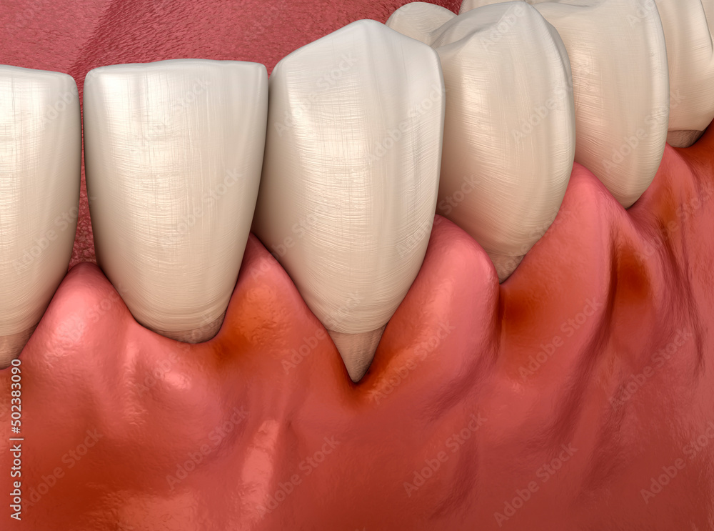 Gingivitis inflammation of the gums. Dental 3D illustration Stock ...