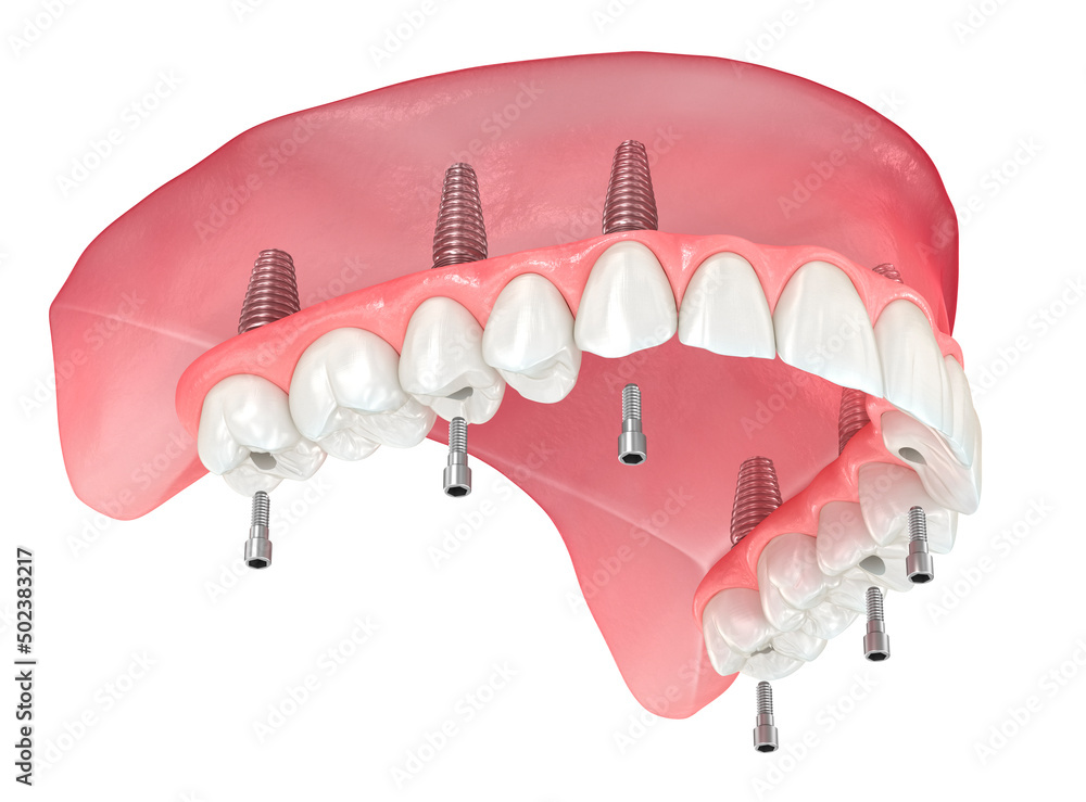 Maxillary prosthesis with gum All on 6 system supported by implants ...