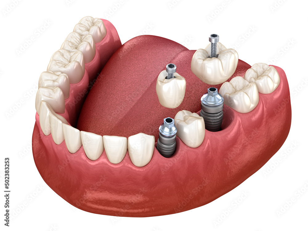 Premolar and Molar tooth crown installation over implant, screw ...