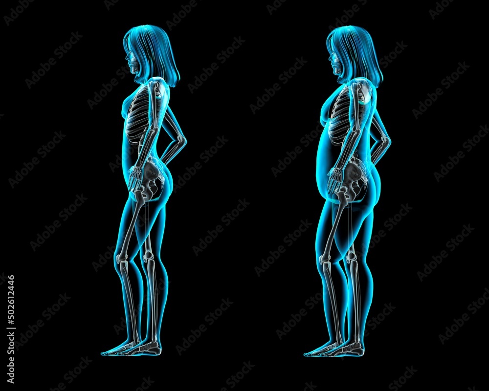 Obese and thin women posing in catwalk style, X-ray image Stock ...
