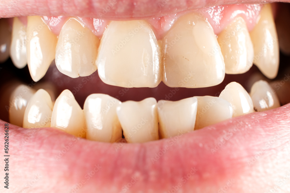Teeth with tartar and caries, crooked lower foreground incisors, close ...
