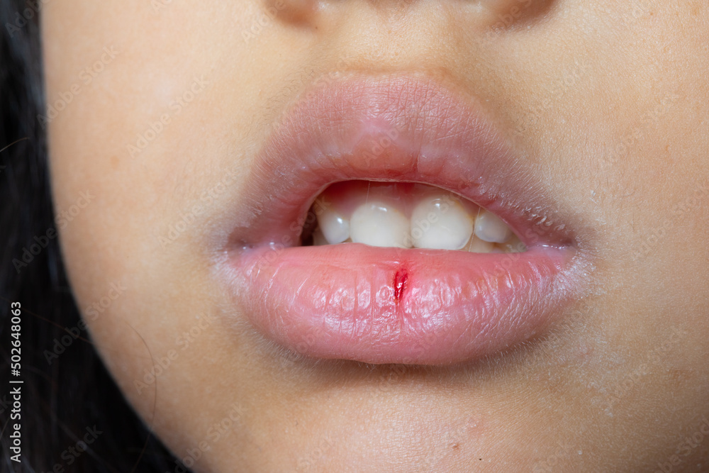 Girl dry lips with open cracks and blood Stock Photo | Adobe Stock