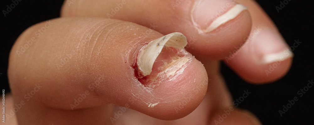Fingernail Falling Off