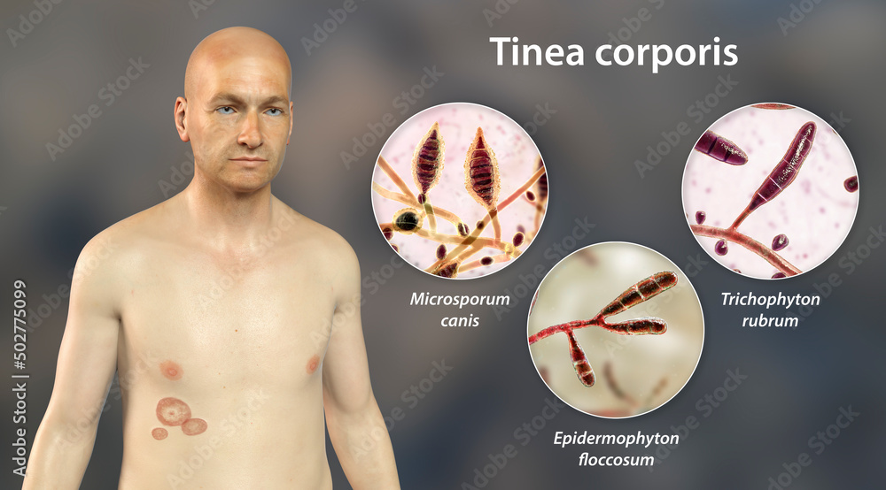 Fungal infection on a man's body. Tinea corporis, 3D illustration Stock ...