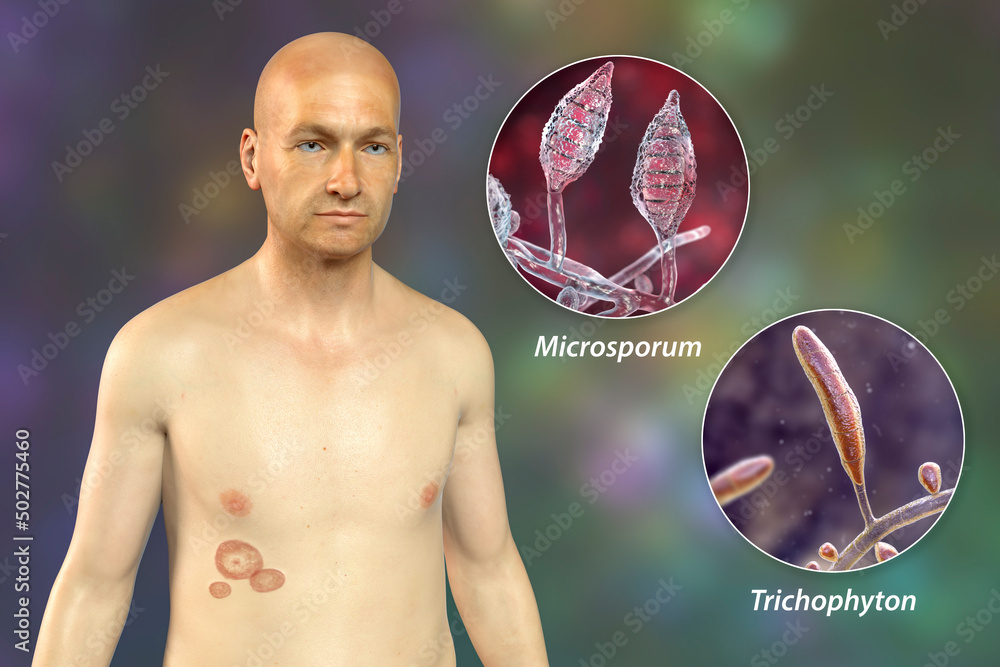 Fungal infection on a man's body. Tinea corporis, 3D illustration Stock ...