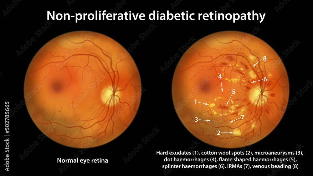 Non-proliferative diabetic retinopathy, illustration Stock Illustration ...