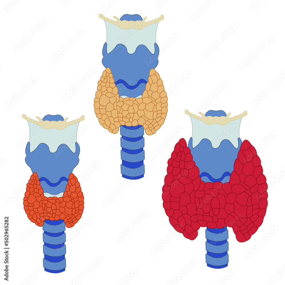 thyroid gland in three states is isolated on a white background. Image ...
