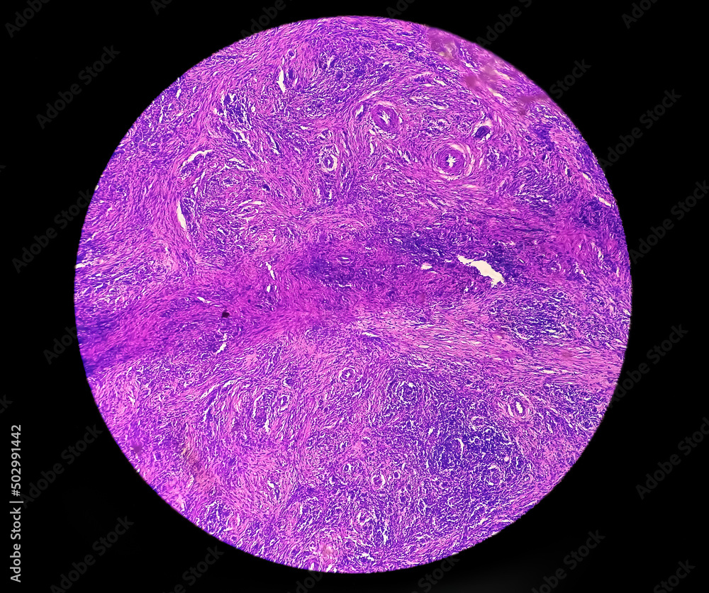 Skin Cancer: Skin biopsy under microscope showing Basal cell carcinoma ...