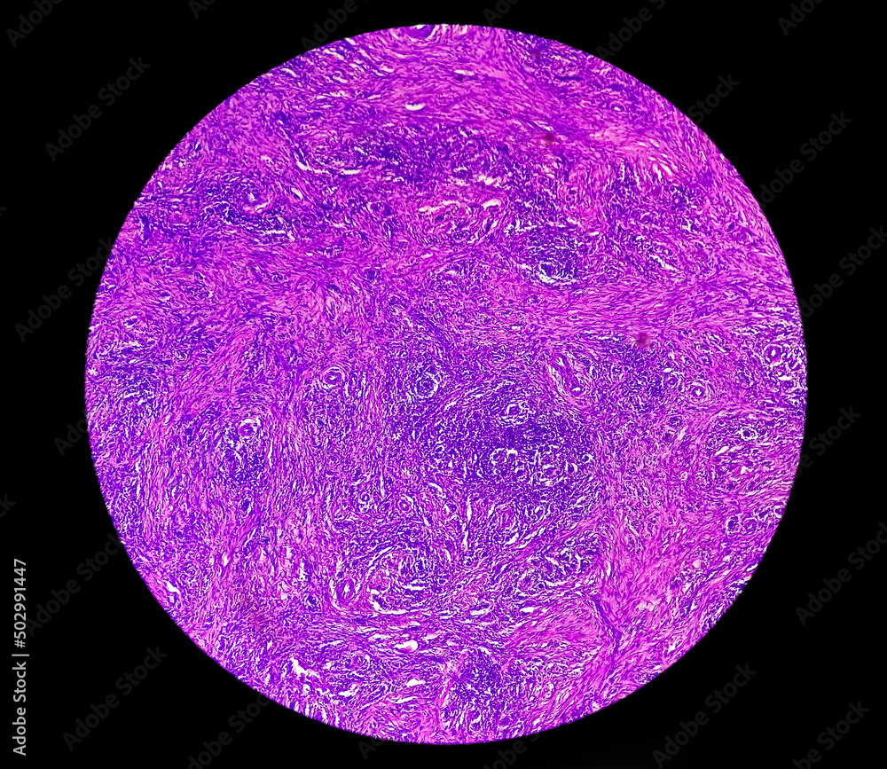 Skin Cancer: Skin biopsy under microscope showing Basal cell carcinoma ...