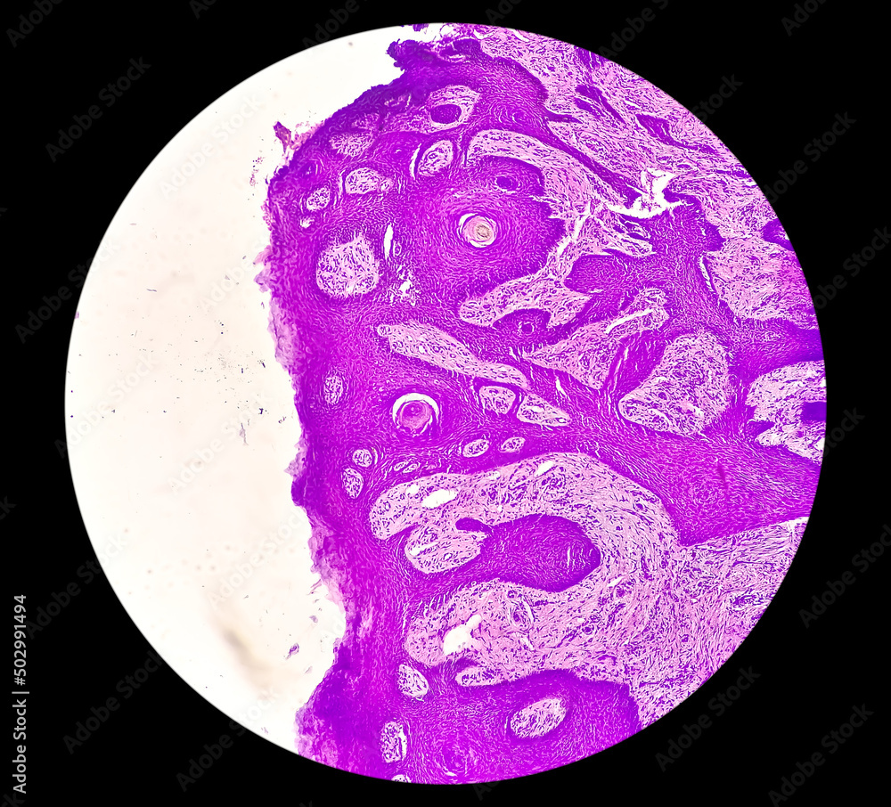 Skin Cancer: Skin biopsy under microscope showing Basal cell carcinoma ...