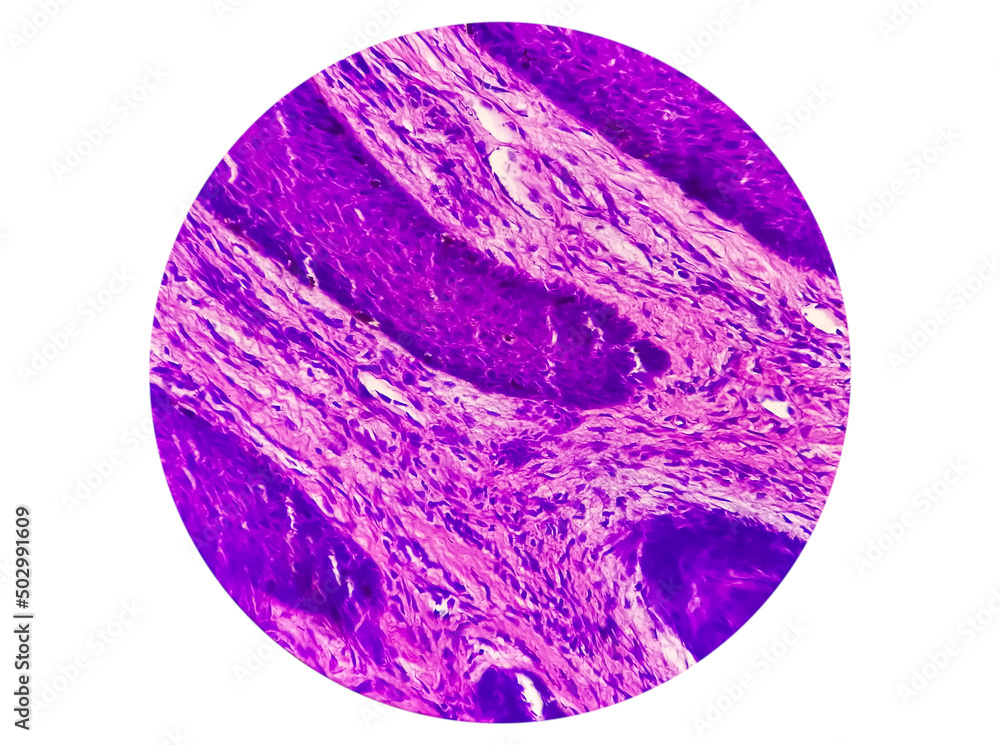 Skin Cancer: Skin biopsy under microscope showing Basal cell carcinoma ...
