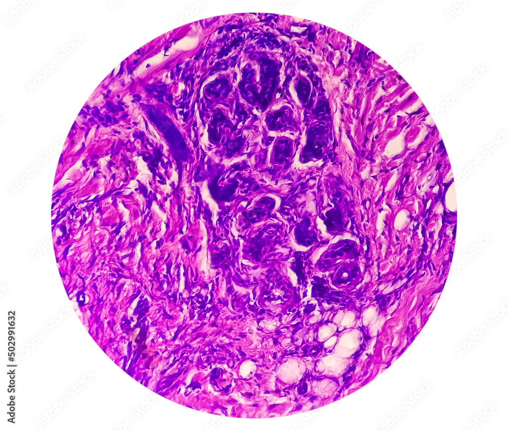 Skin Cancer: Skin biopsy under microscope showing Basal cell carcinoma ...