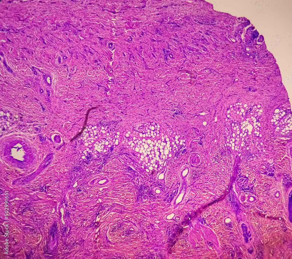 Skin Cancer: Skin biopsy under microscope showing Basal cell carcinoma ...